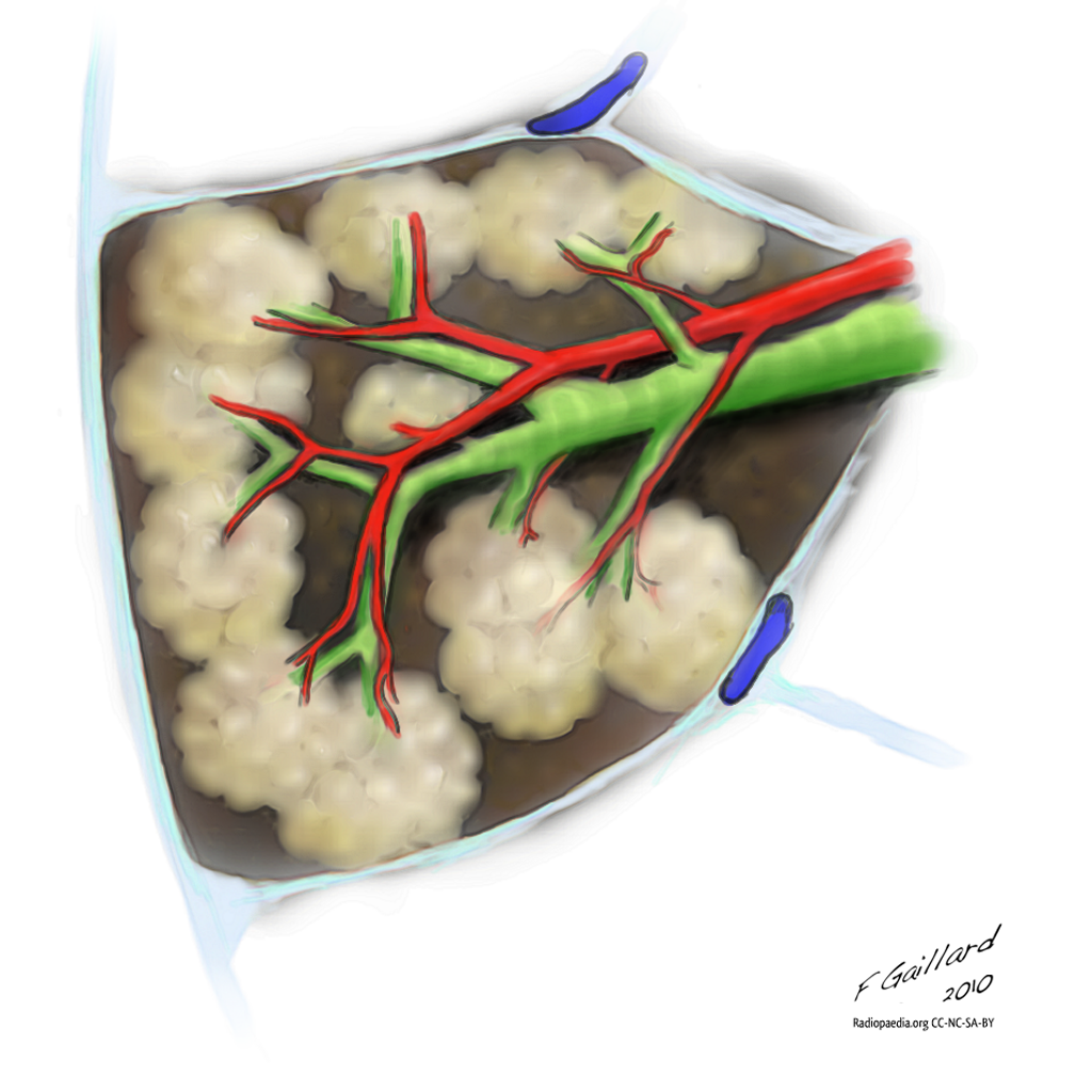 Radiopaedia - Drawing Secondary pulmonary lobule and related structures ... Radiopaedia - Drawing Secondary pulmonary lobule and related structures ...
